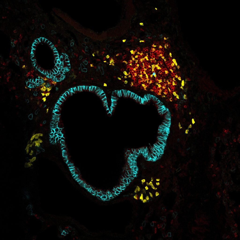 CCR2 Influences T Regulatory Cell Migration to Tumors and Serves as a ...